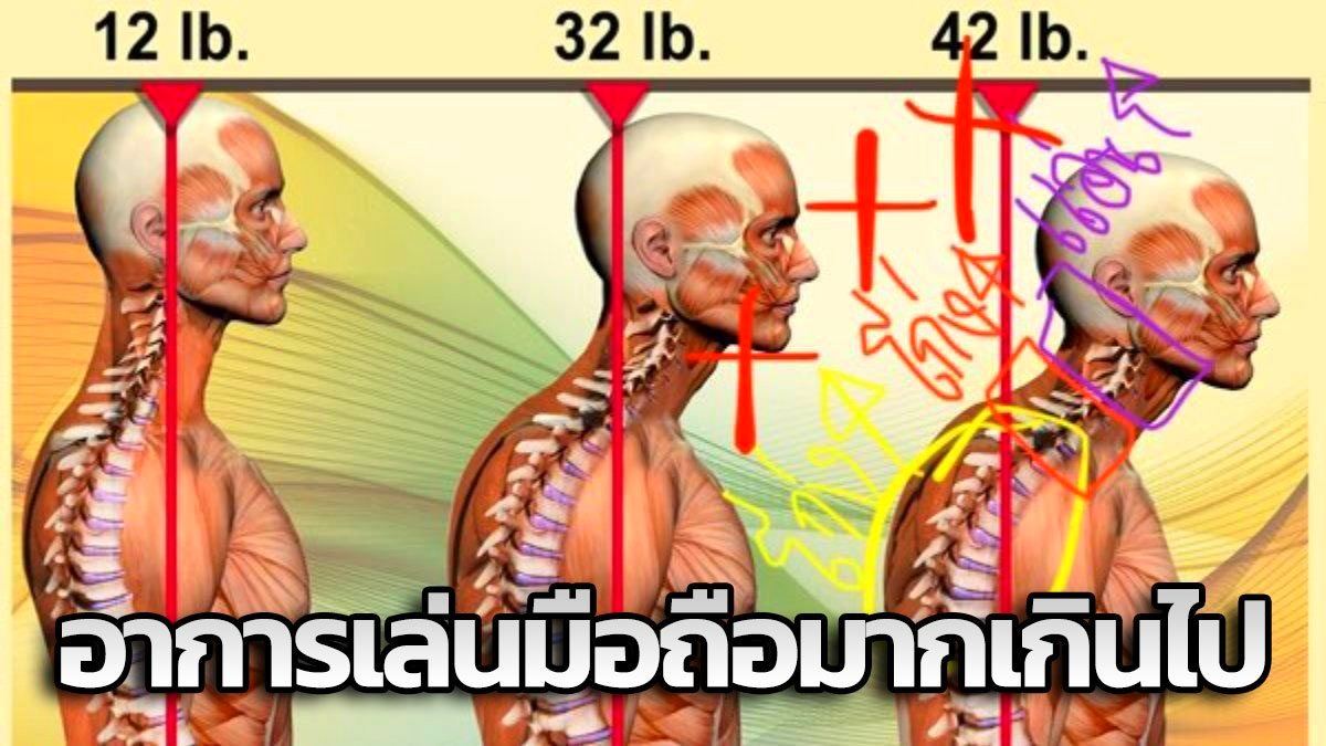 กระดูกคอเสื่อม